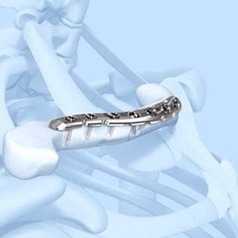 3.5 mm LCP® Superior and Superior Anterior Clavicle Plate – Welcome to ...