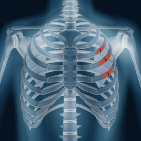 Broken Rib: Symptoms and Diagnosis – Welcome to SYS Medtech ...