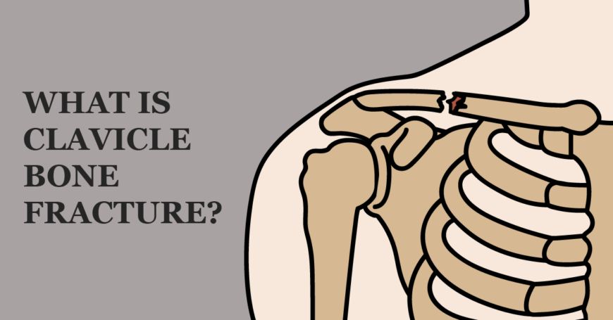 What Is Clavicle Bone Fracture Welcome To Sys Medtech International Pvt Ltd