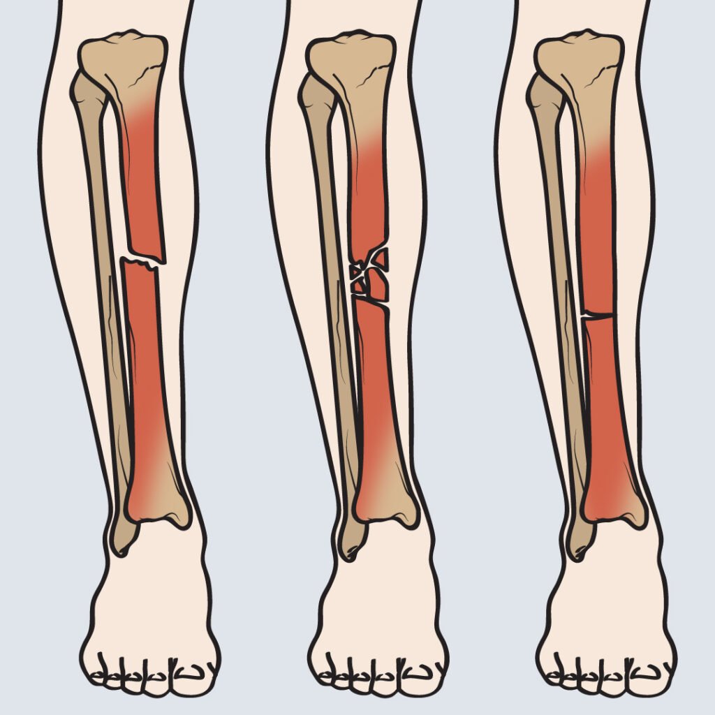 Types Of Tibia Fracture Welcome To SYS Medtech International Pvt Ltd 