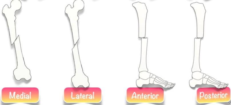 Types of Bone Fractures: Causes, Symptoms, and Treatment – Welcome to ...