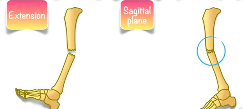 Types of Bone Fractures: Causes, Symptoms, and Treatment – Welcome to ...